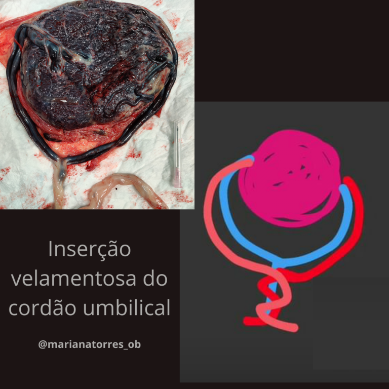 Inserção velamentosa do cordão umbilical | Mariana Torres OB